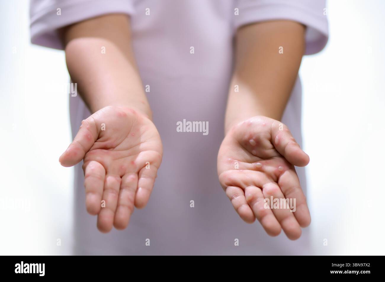 Hand, foot and mouth disease HFMD Human hand of scarlet fever in ...
