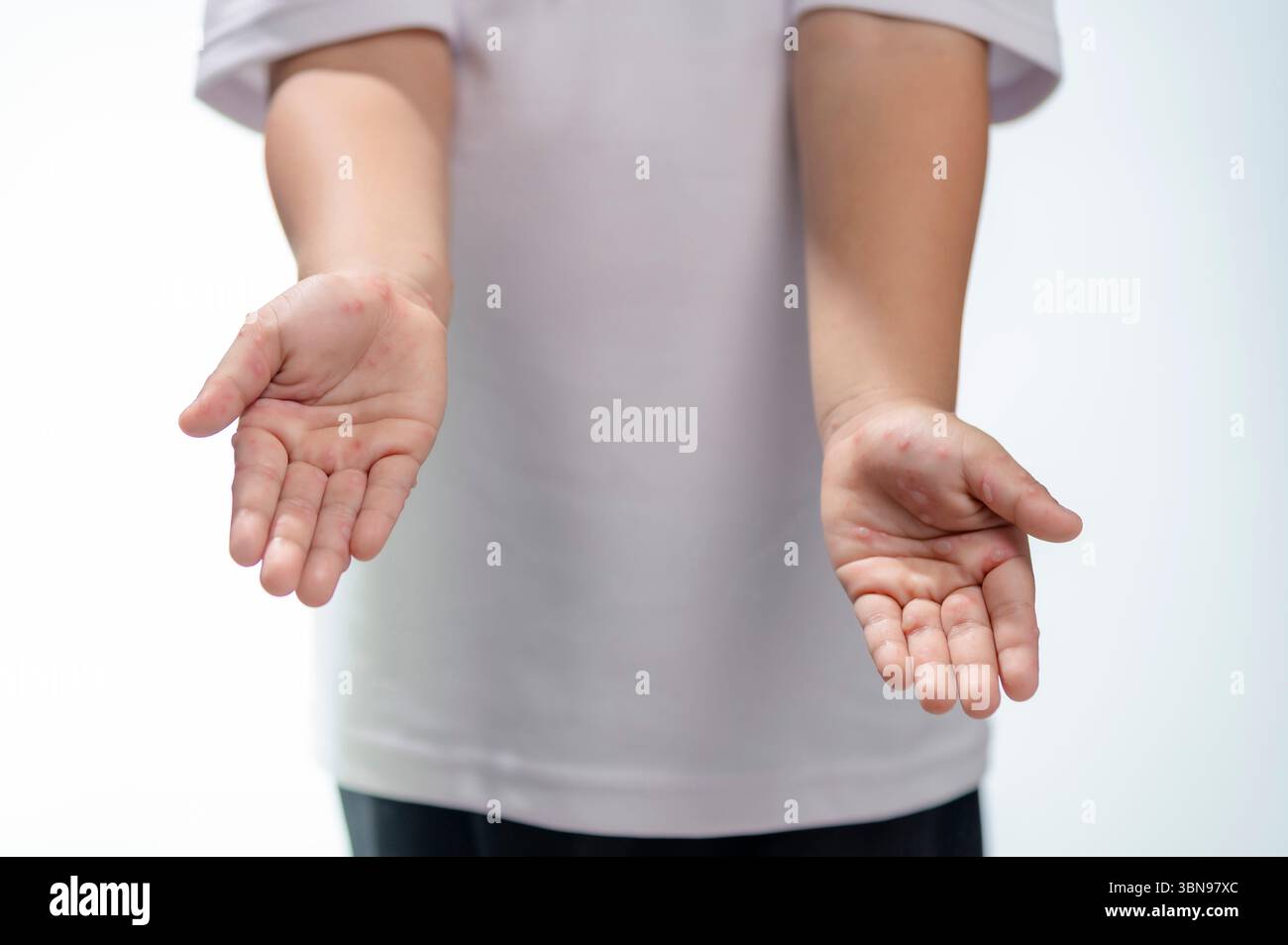 Hand, foot and mouth disease HFMD Human hand of scarlet fever in ...
