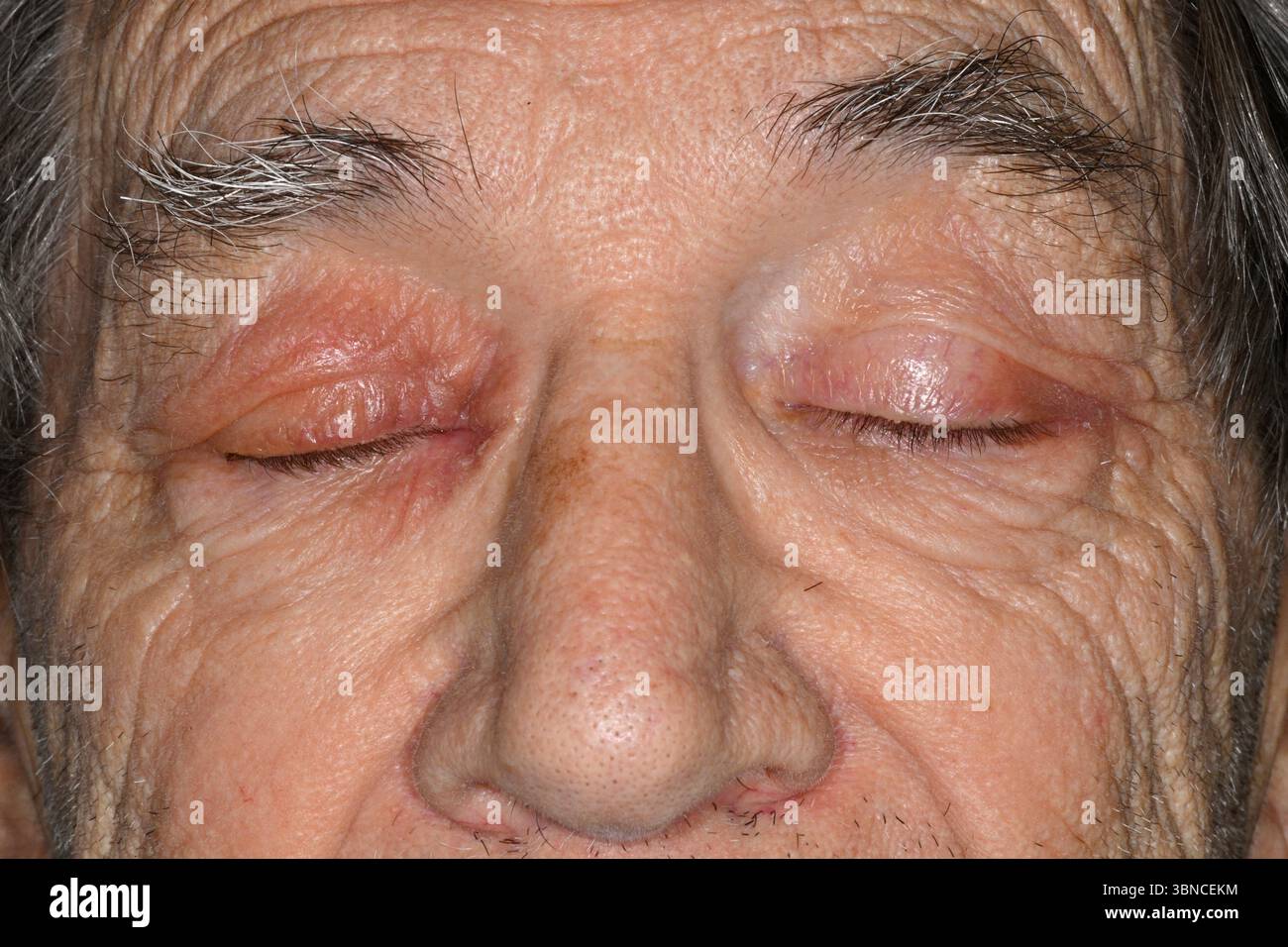 Periocular dermatitis in 78 year old male patient. This is a common ...