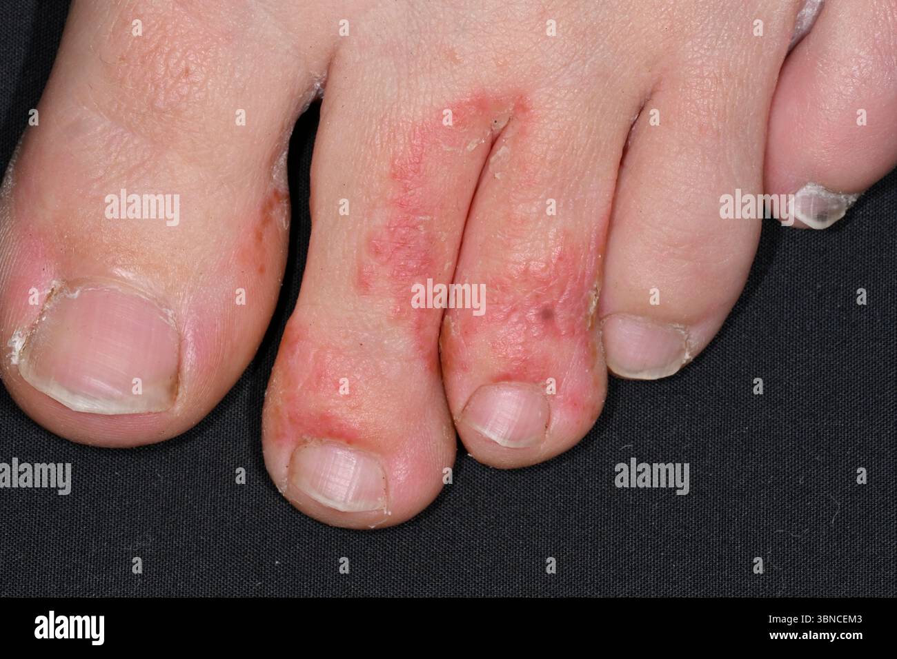 Tinea pedis, also known as athlete's foot, on the toes of a 39 year old ...