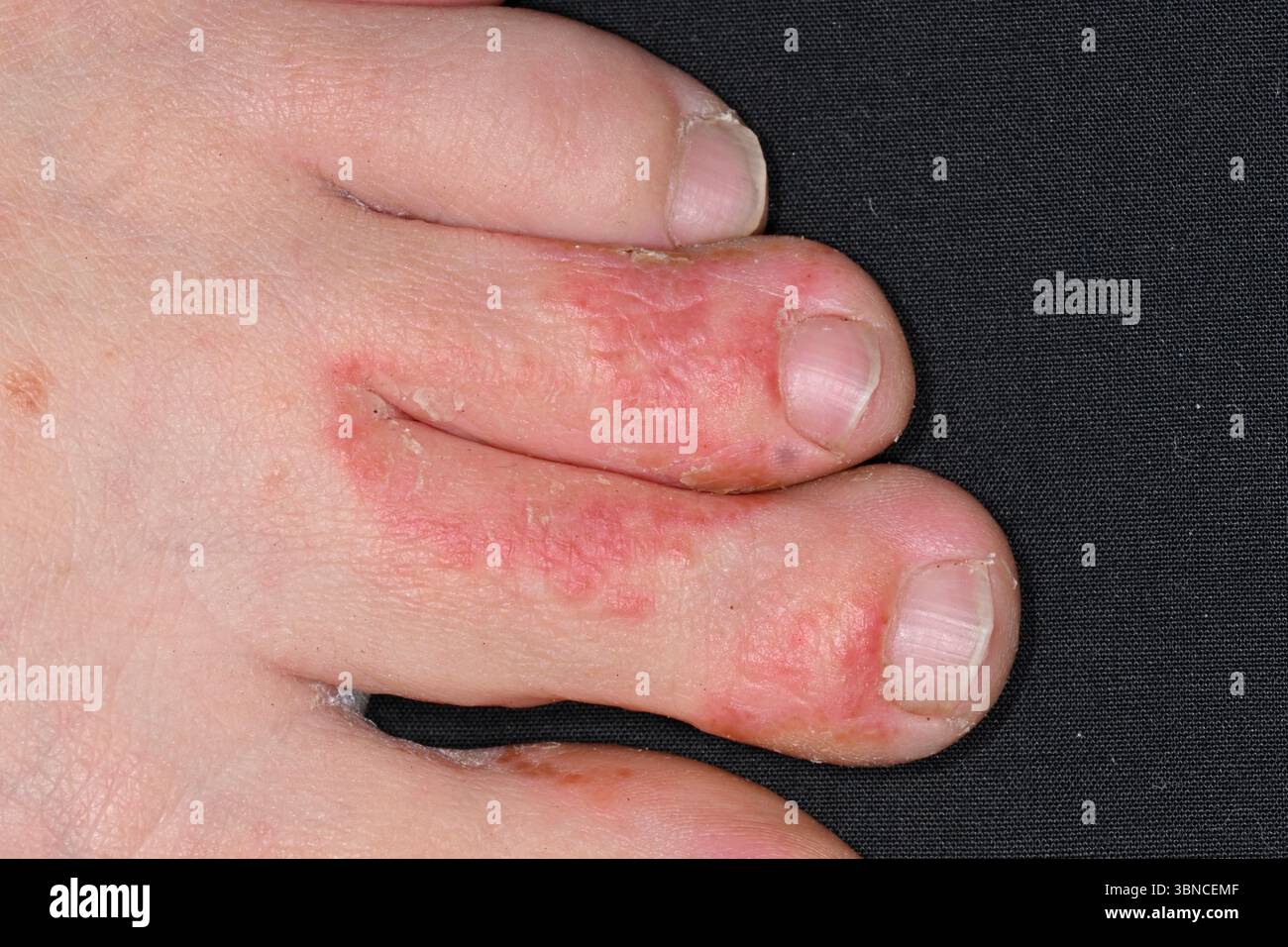 Tinea pedis, also known as athlete's foot, on the toes of a 39 year old ...