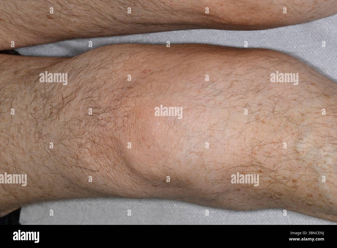 Swelling due to bursitis in the knee of a 78 year old male patient ...