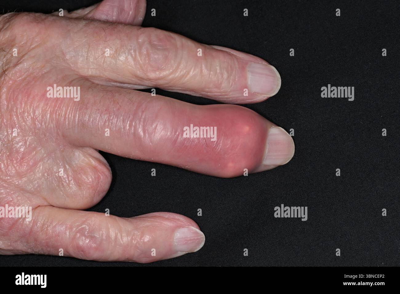 Swelling in the finger of a 88 year old male patient due to gout. The ...