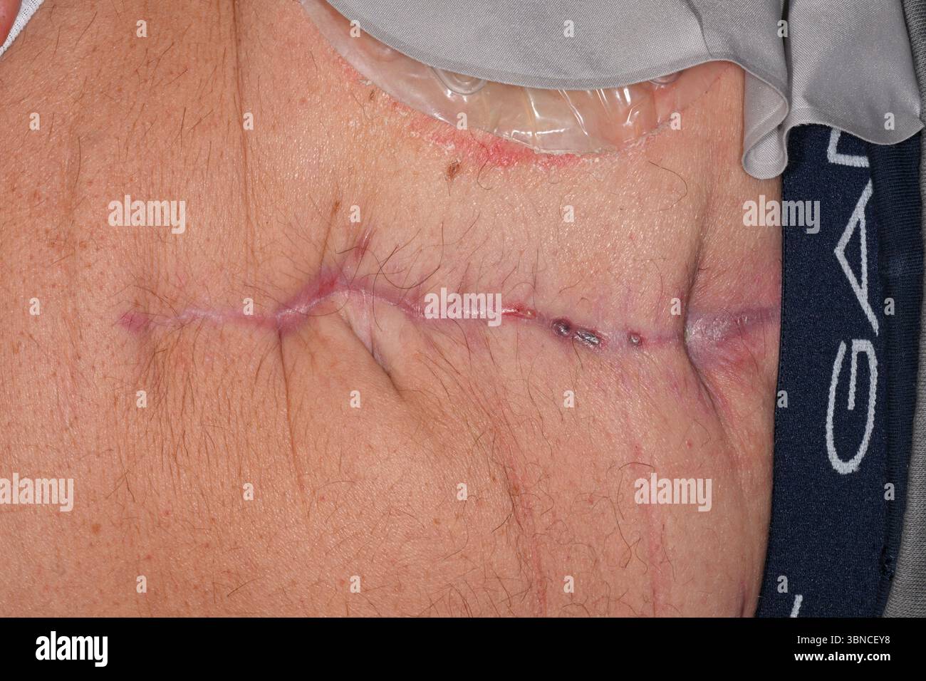 Abdominal wound healing following the Hartmann's procedure in a 57 year ...