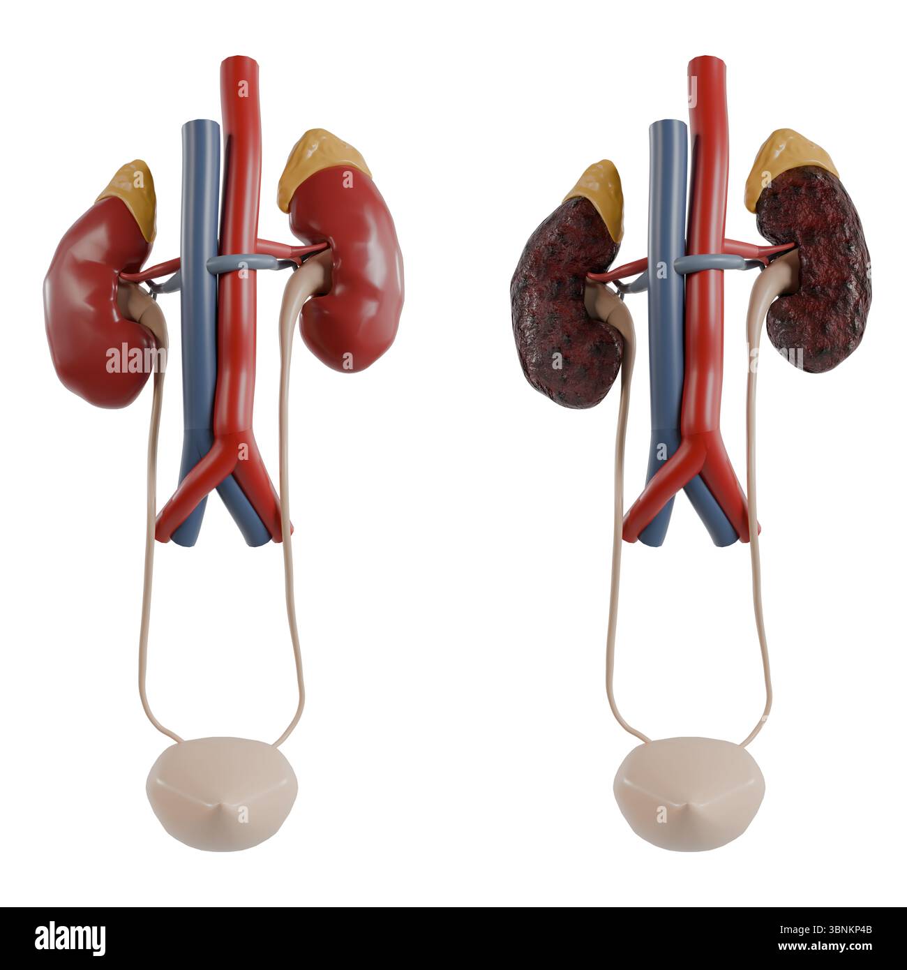 Human kidney anatomy comparison with healthy and diseased organ showing ...