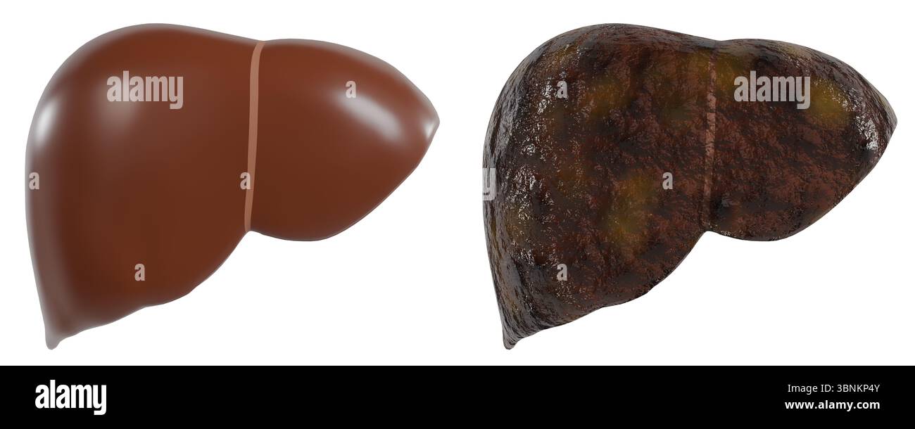 Human liver comparison model showing healthy organ and cirrhosis damage ...