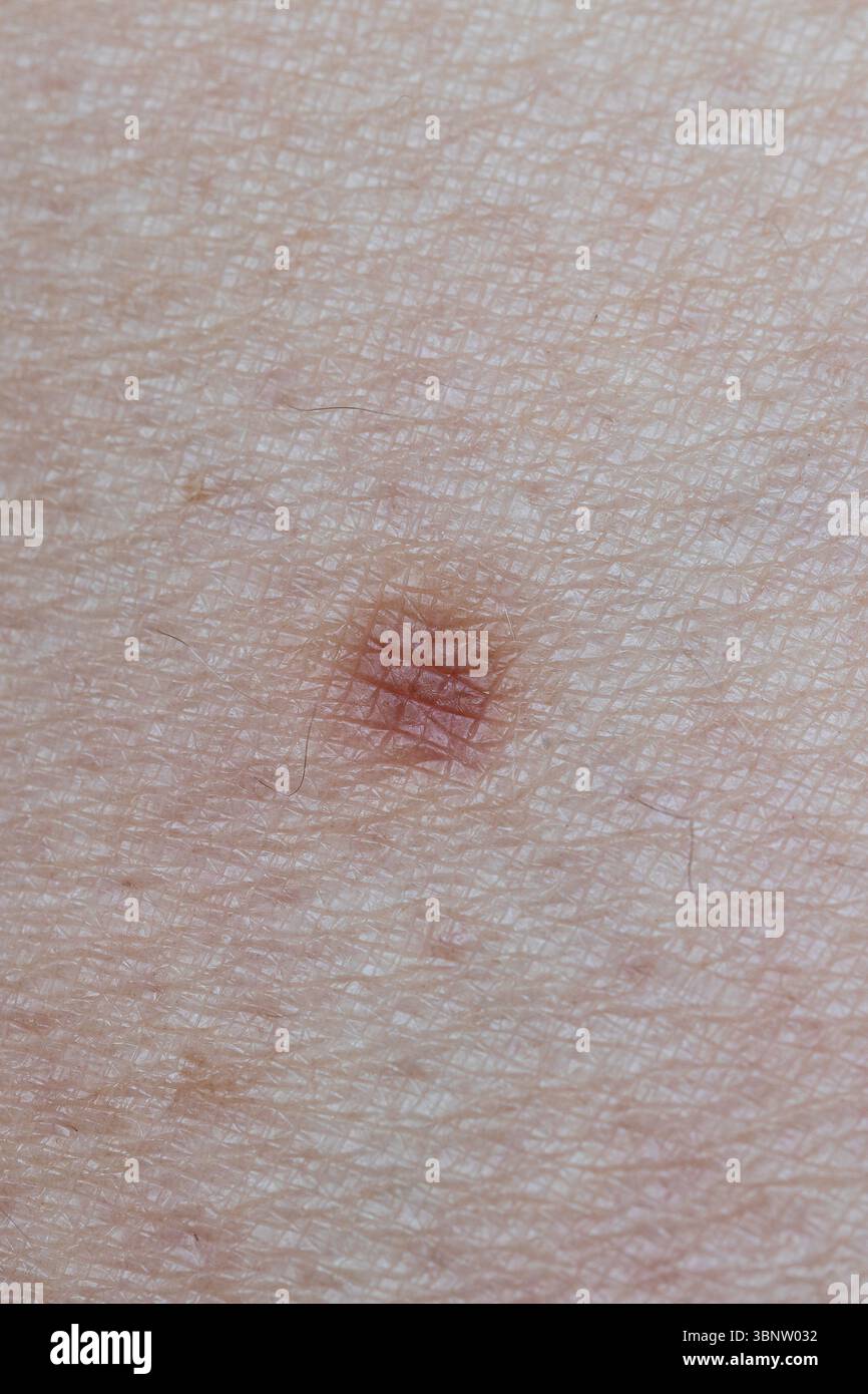 Early melanoma detection hi-res stock photography and images - Alamy