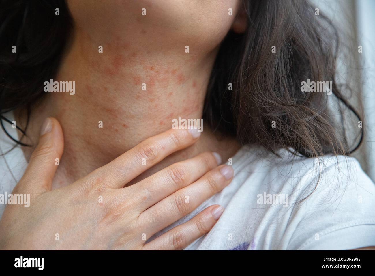 Close-up of a woman’s neck showing an allergic skin reaction with ...