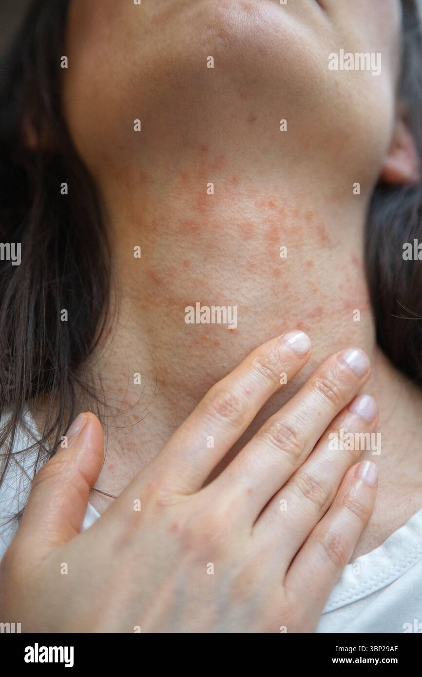 Eczema atopic dermatitis symptom skin hi-res stock photography and ...