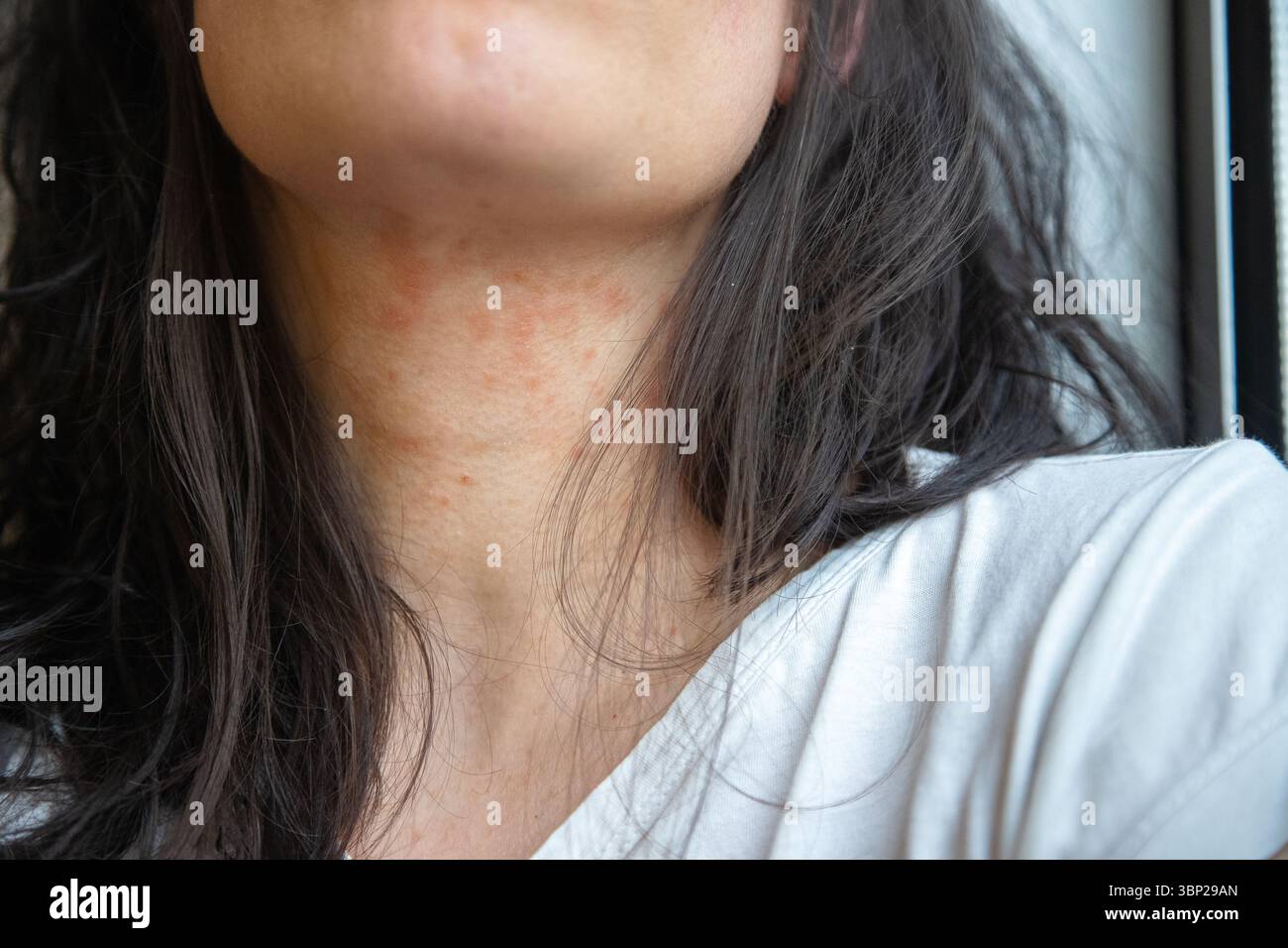 Close-up of a woman’s neck showing an allergic skin reaction with ...