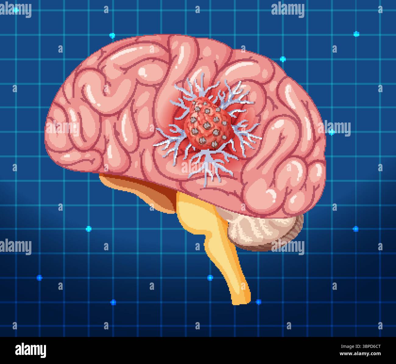 Detailed vector illustration of a brain highlighting a cancer cell ...