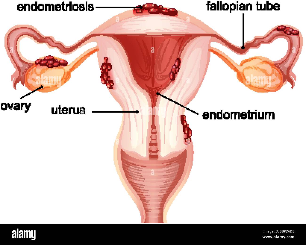 Vector illustration highlighting endometriosis in the female reproductive system, featuring ...