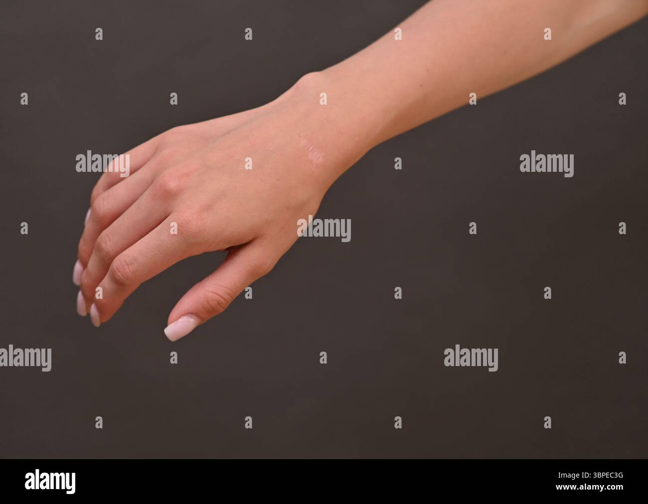 Close-up of female hand with visible surgical scar from removed ...