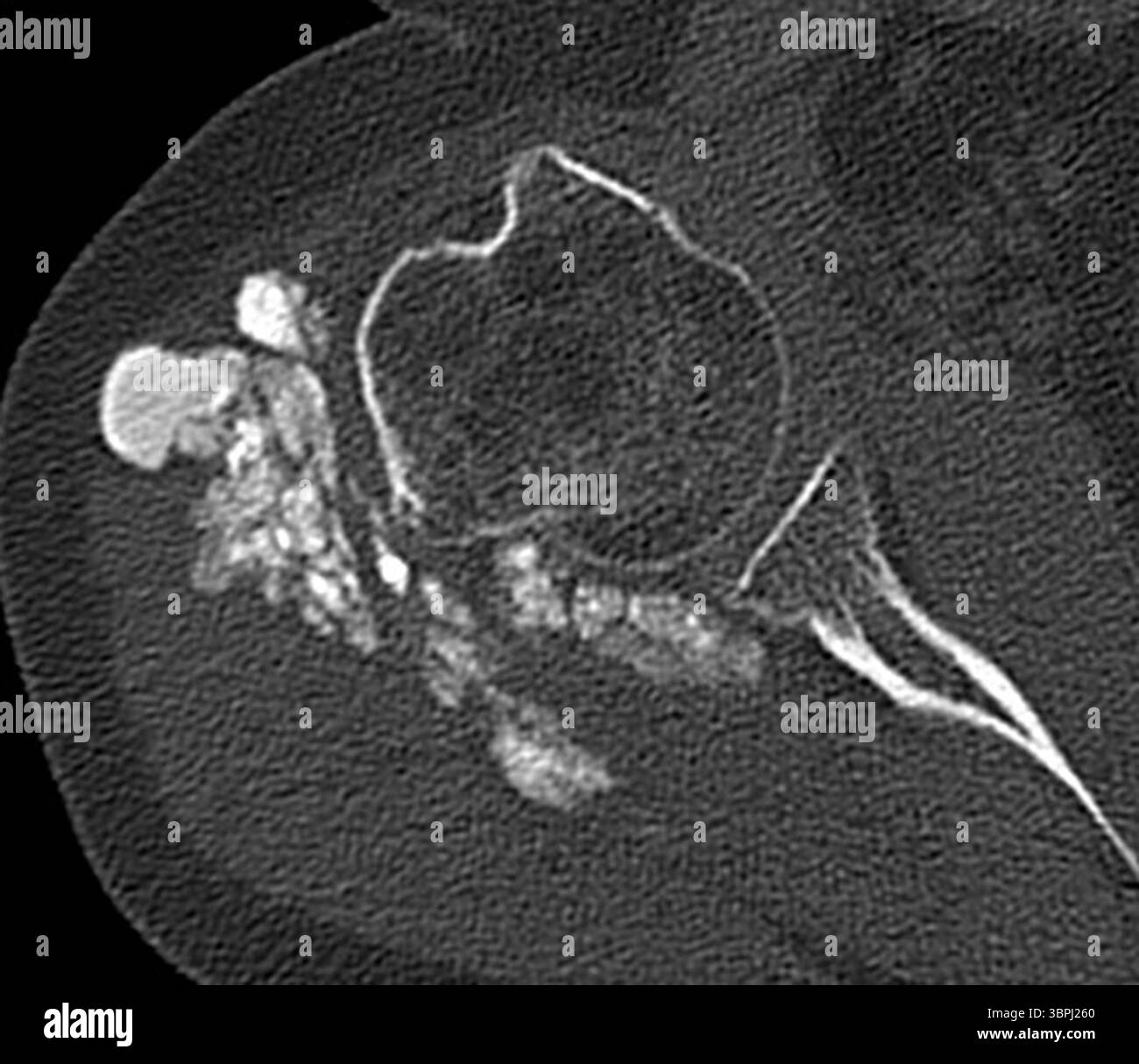 X-ray of the shoulder of a 49 year old woman revealing systemic ...