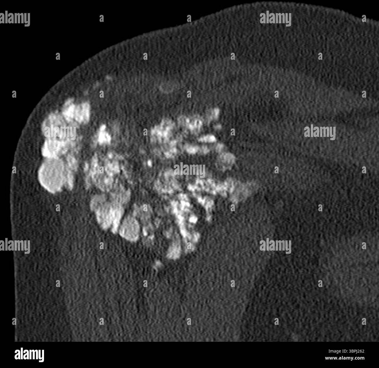 X-ray of the shoulder of a 49 year old woman revealing systemic ...