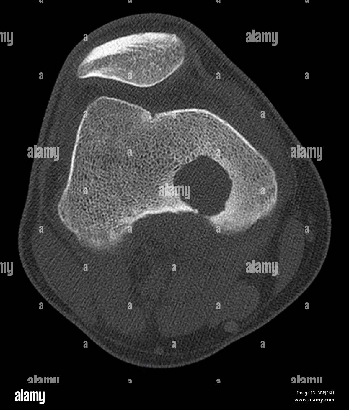 Computed tomography (CT) axial scan of the knee of a 9 year old boy ...