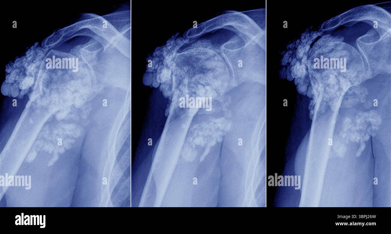 X-ray of the shoulder of a 49 year old woman revealing systemic ...