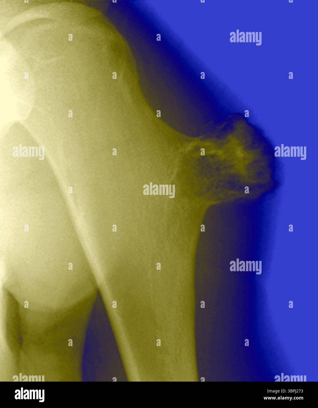 Coloured X-ray of of the arm of a 15 year old male patient reveals an ...