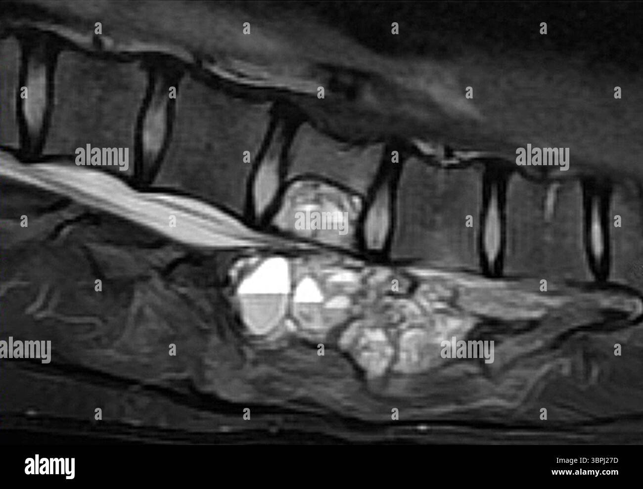 Magnetic resonance image (MRI) scan of the spine of a 15 year old male ...