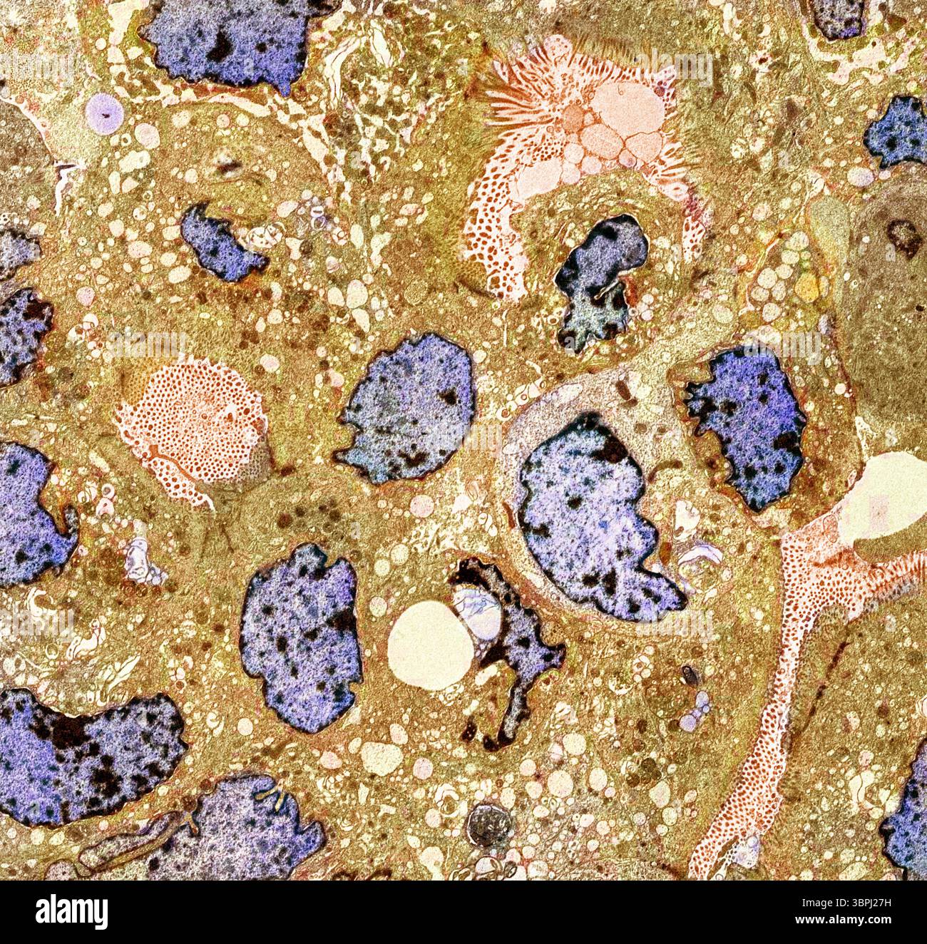 Stomach cancer. Coloured transmission electron micrograph (TEM) of a ...