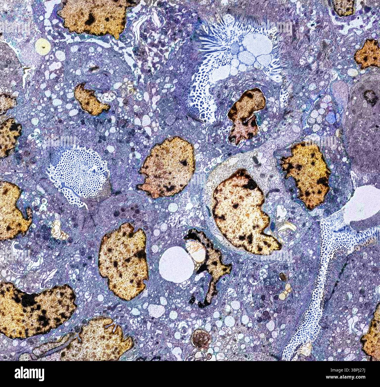 Stomach cancer. Coloured transmission electron micrograph (TEM) of a ...