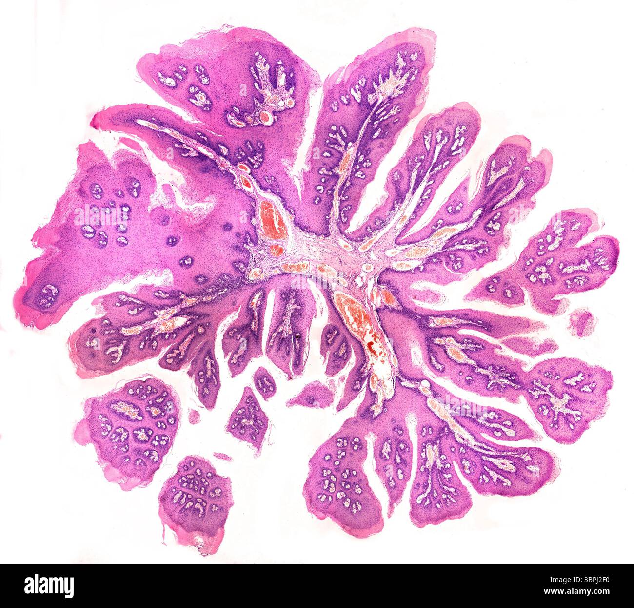 Light micrograph of a papilloma located in the mouth uvula. A papilloma ...