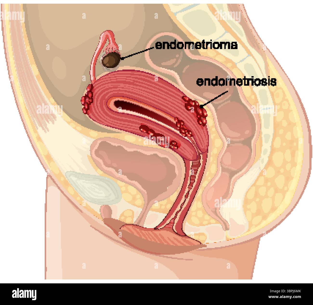 Vector illustration showing endometriosis and endometrioma in the female reproductive system ...