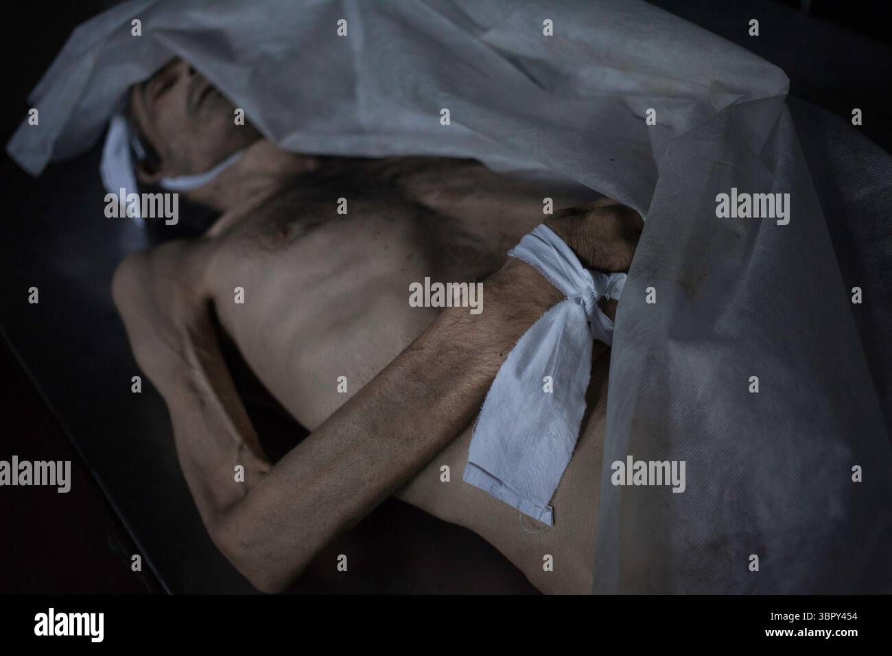 Body of a man who died of tuberculosis, morgue of the State Hospital ...