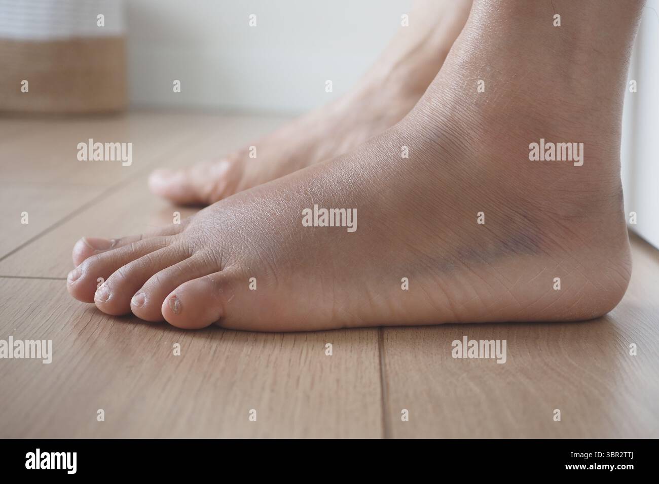 close up of women feet with swelling Stock Photo - Alamy