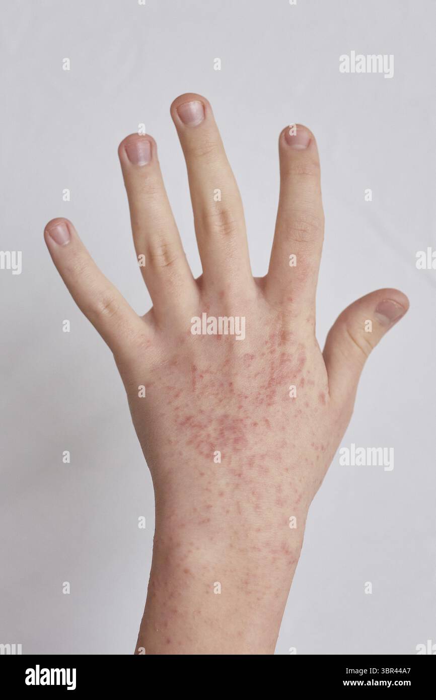 Allergic reactions on the skin of the hands patient. Ill allergic rash ...