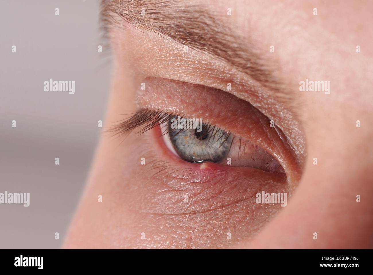 Ocular inflammation of barley (Hordeolum) on the lower eyelid in a man ...