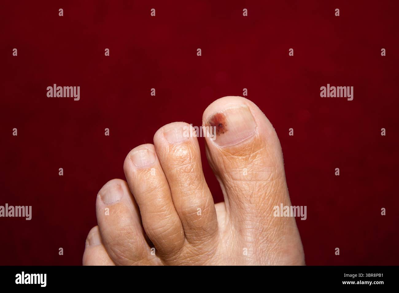 Subungual hematoma bruise under nail hi-res stock photography and ...