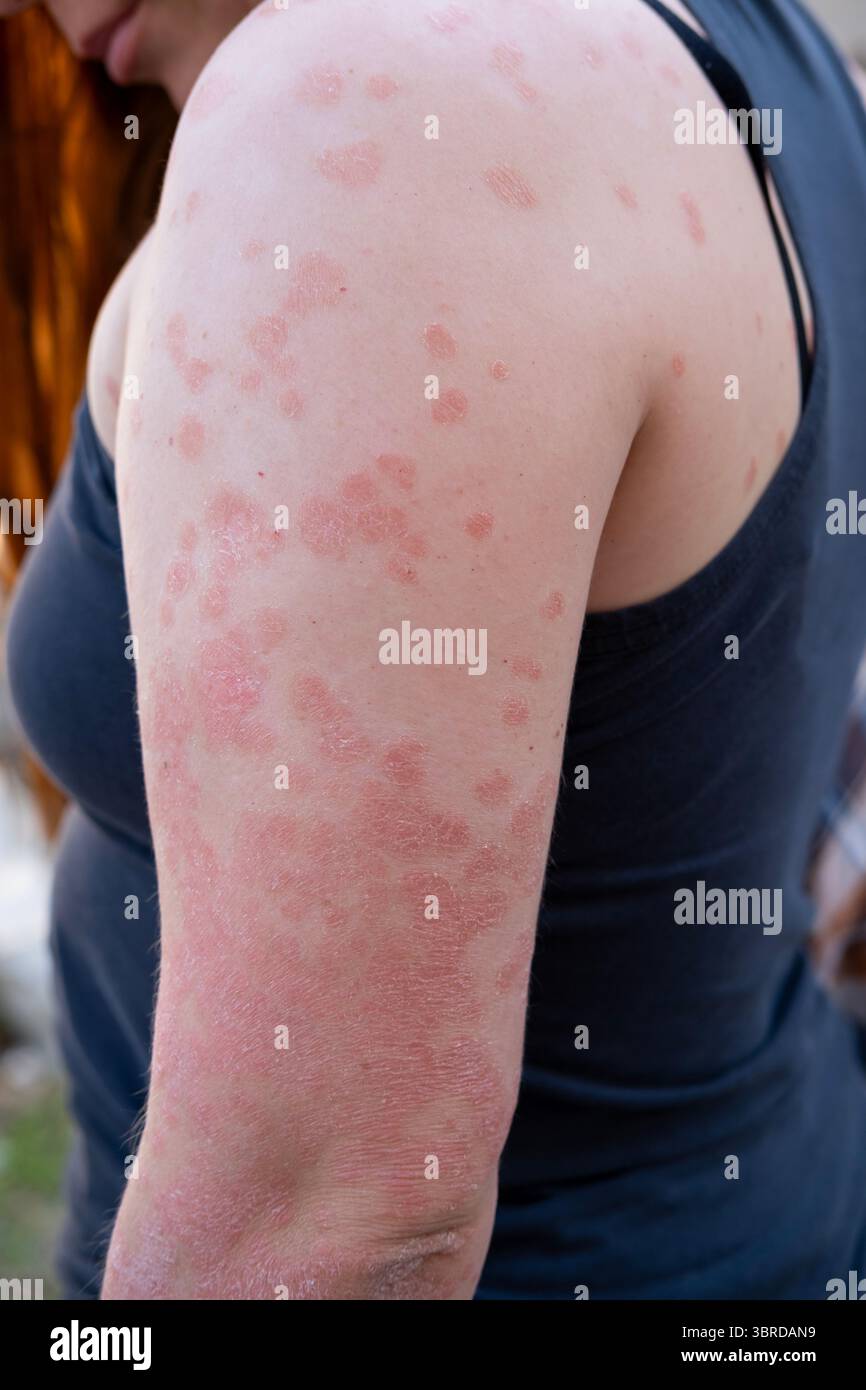 Psoriasis acute psoriasis elbows hi-res stock photography and images - Alamy