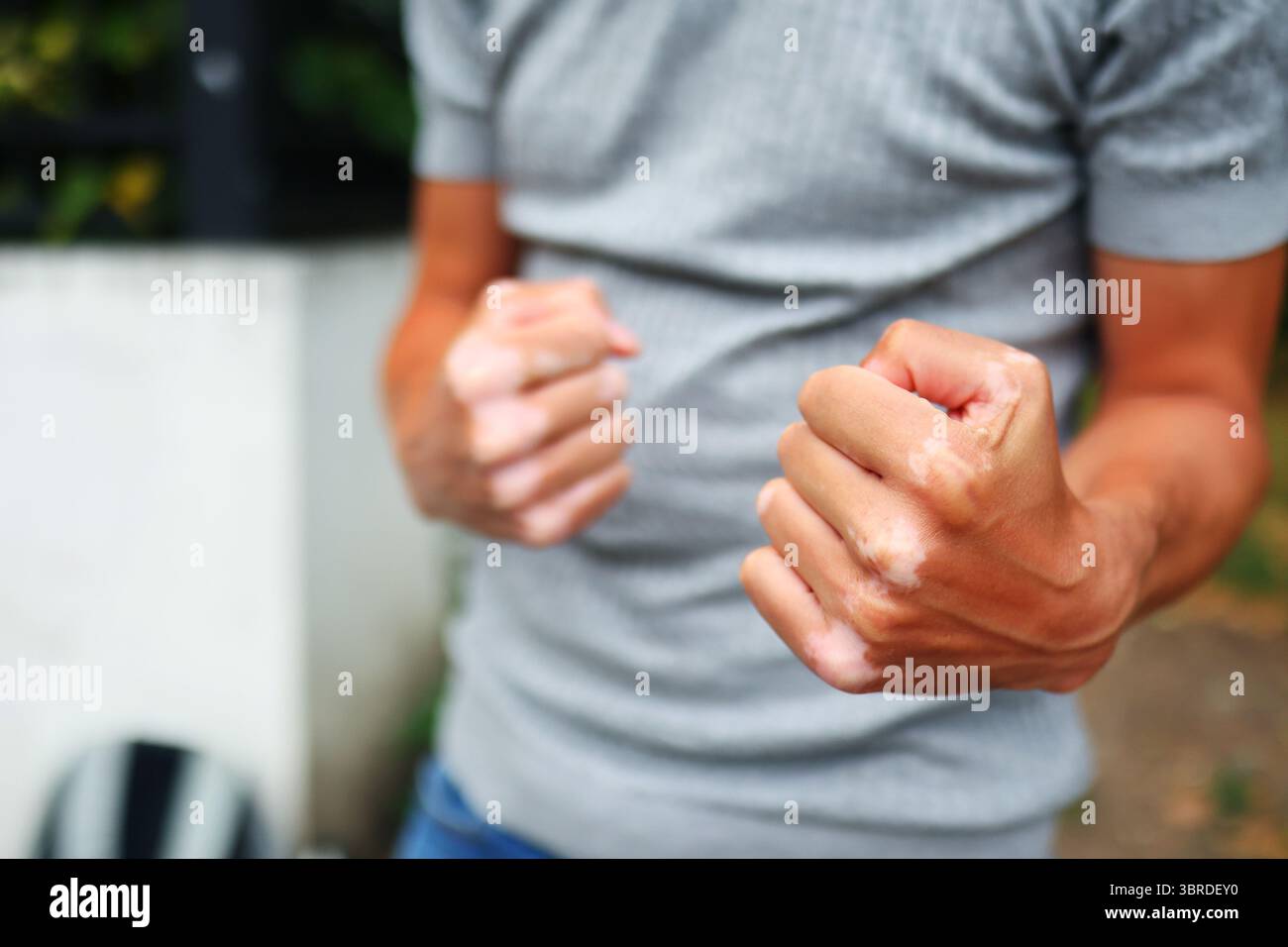 Man with vitiligo showing power stance, a symbol of resilience and body ...