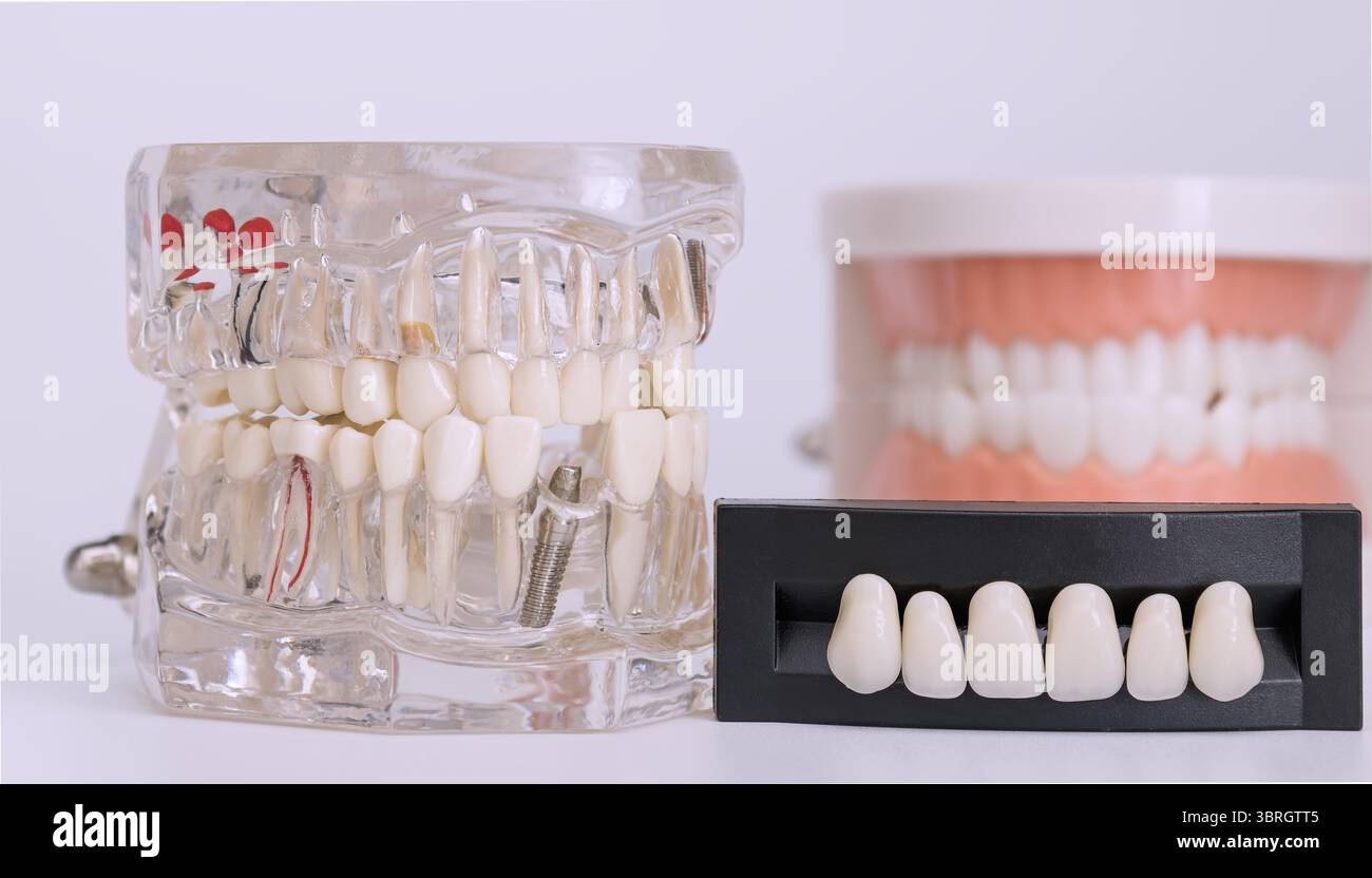 Various dental models showcasing implants, crowns, and prosthetic teeth ...