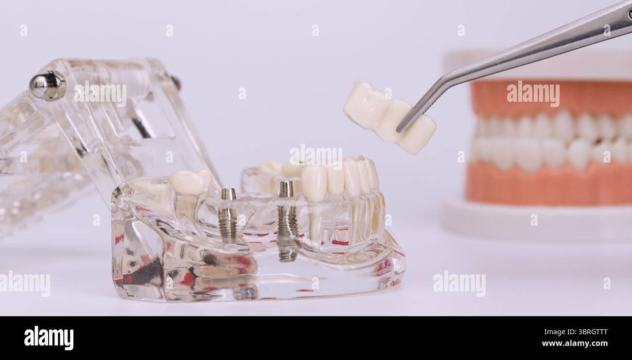 Close-up of dental implant model and prosthetic bridge being positioned ...