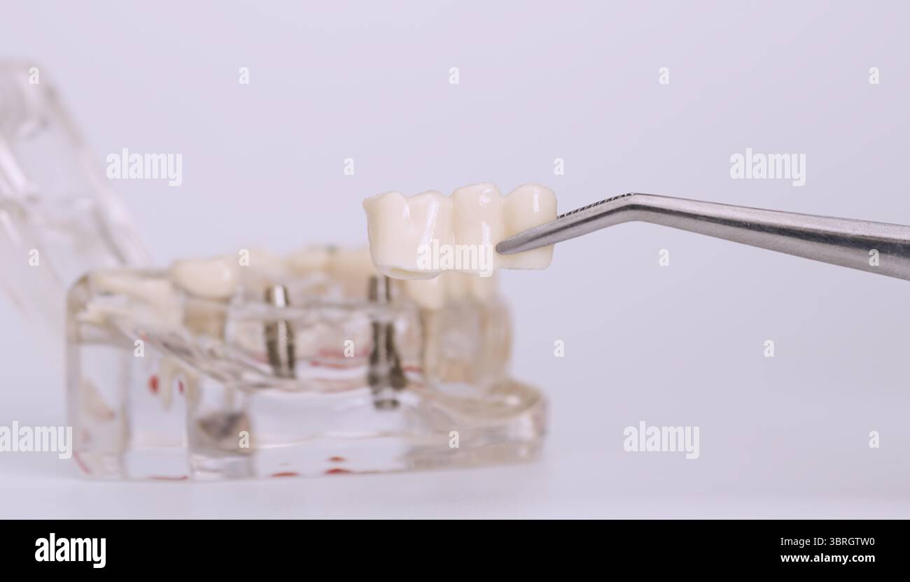 Dental bridge in tweezers hi-res stock photography and images - Alamy