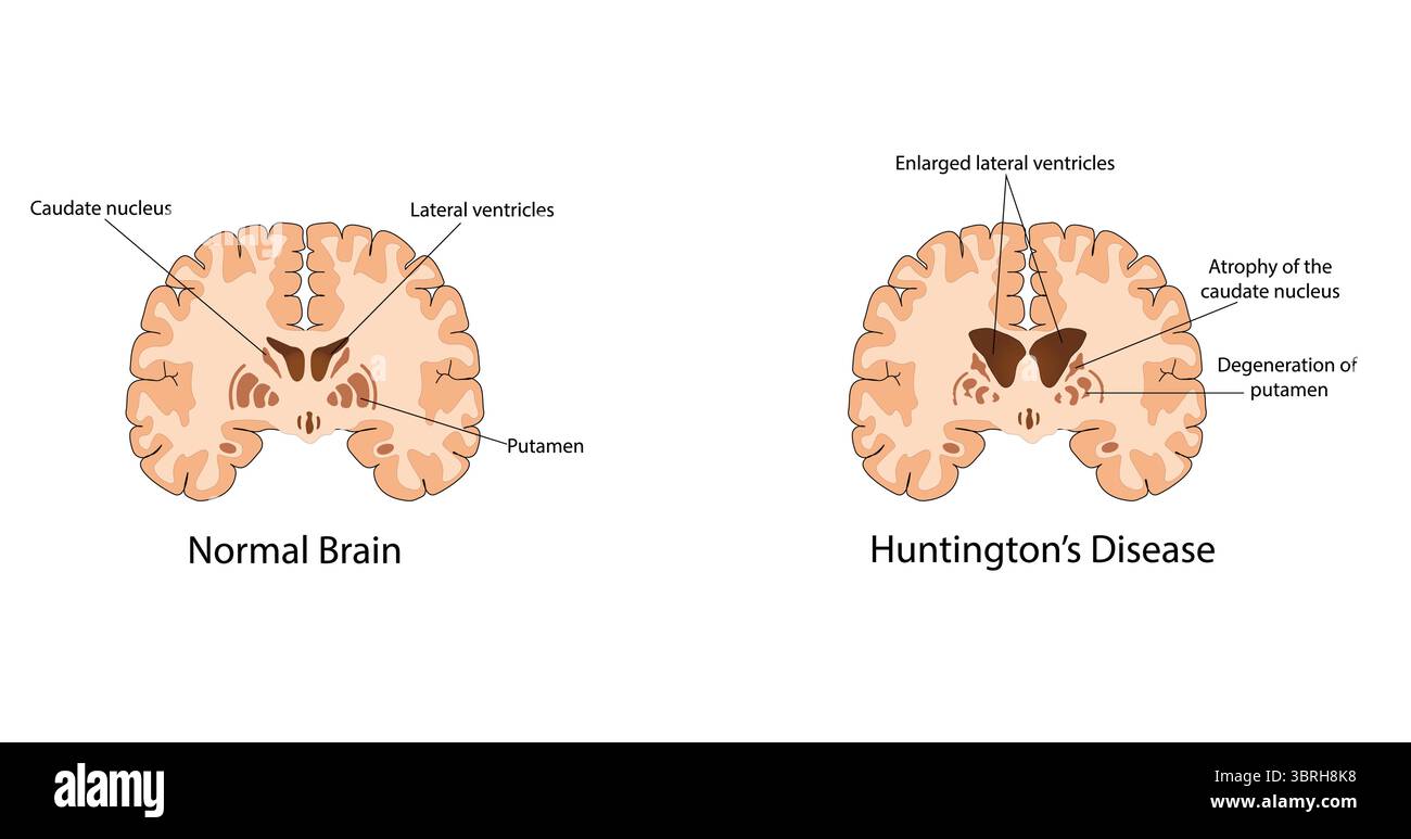 Huntington's disease vector illustration Stock Vector Image & Art - Alamy