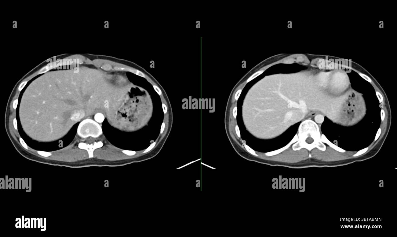 Contrast-enhanced CT whole abdomen study revealing normal anatomical ...