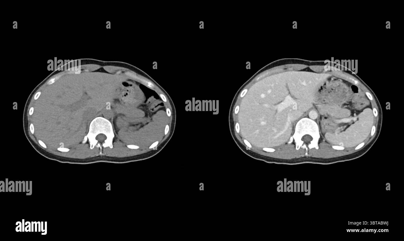 Contrast-enhanced CT whole abdomen study revealing normal anatomical ...