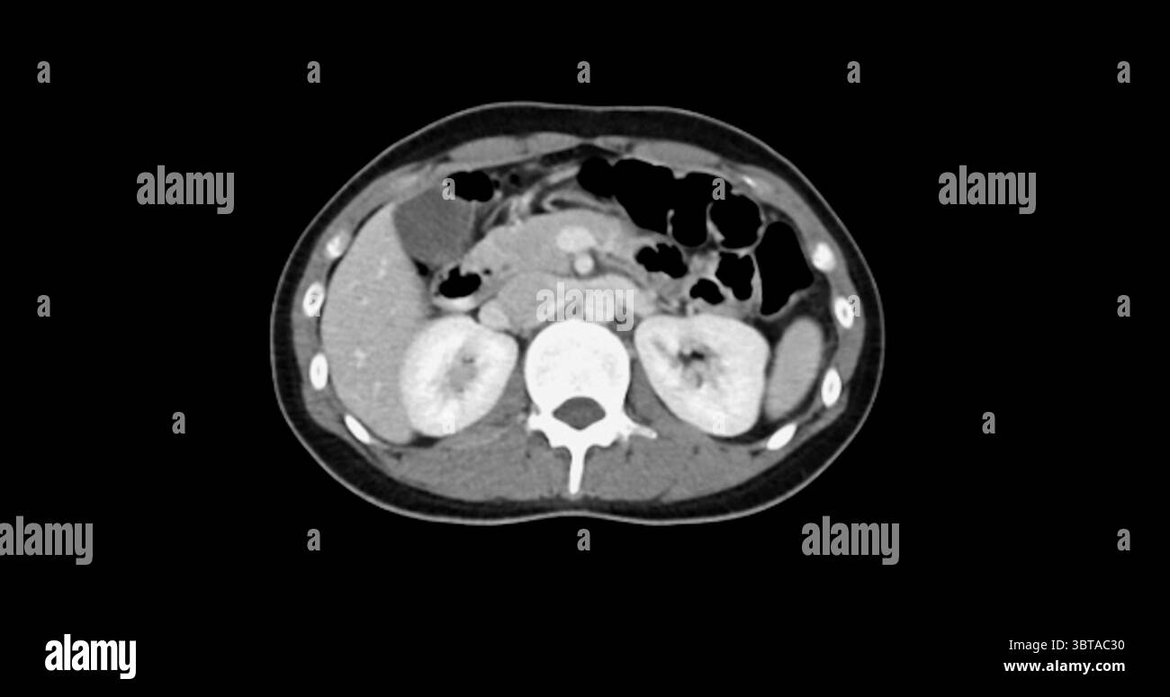 Contrast-enhanced CT whole abdomen study revealing normal anatomical ...