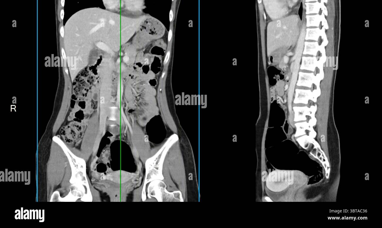 Contrast-enhanced CT whole abdomen study revealing normal anatomical ...