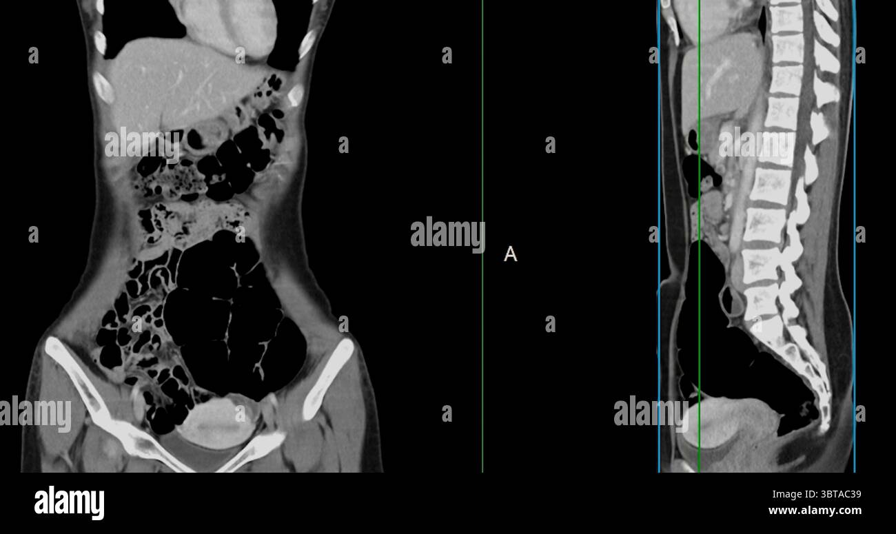 Contrast-enhanced CT whole abdomen study revealing normal anatomical ...