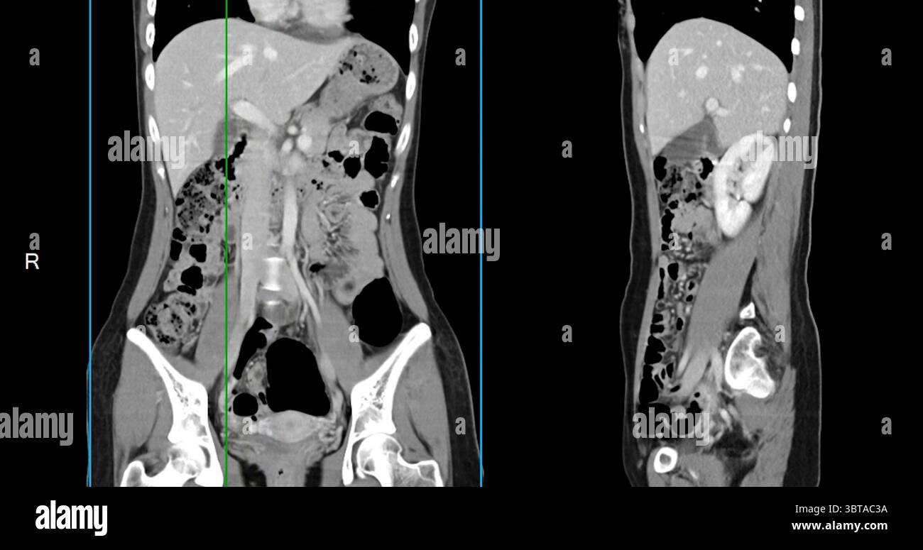 Contrast-enhanced CT whole abdomen study revealing normal anatomical ...