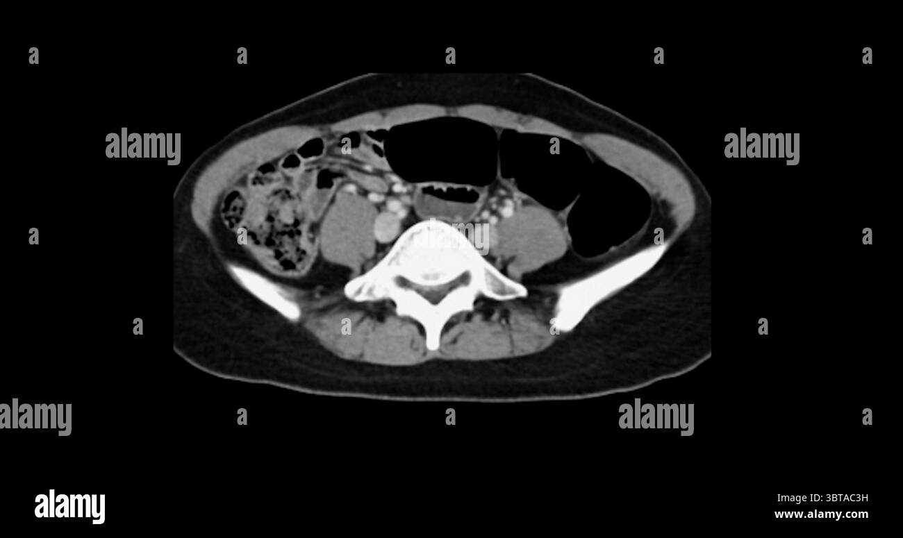 Contrast-enhanced CT whole abdomen study revealing normal anatomical ...