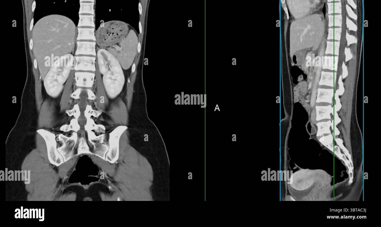 Contrast-enhanced CT whole abdomen study revealing normal anatomical ...