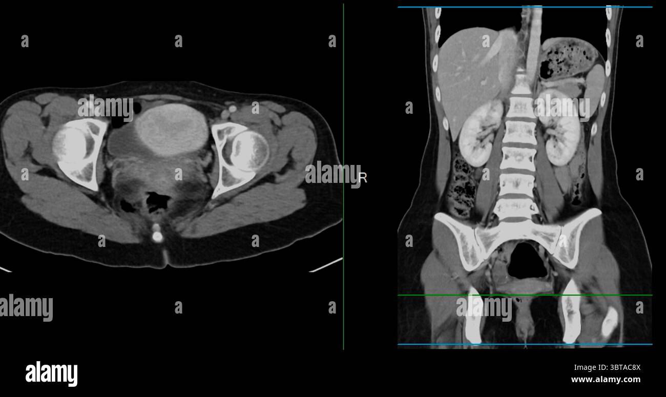 Contrast-enhanced CT whole abdomen study revealing normal anatomical ...