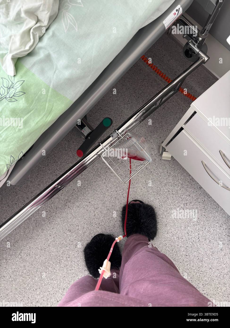 A woman stands by a hospital bed. She displays a postoperative drain. A ...