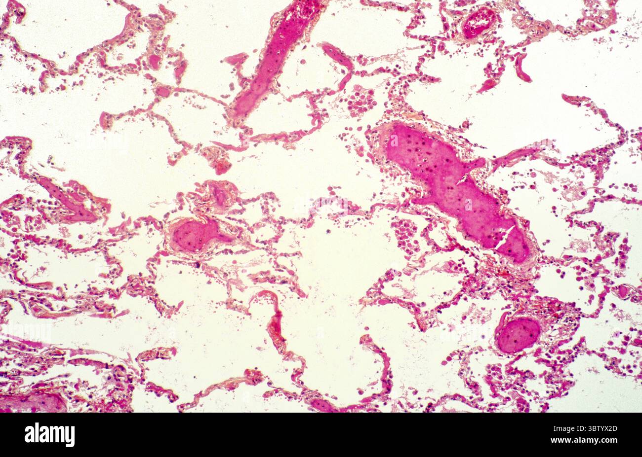 Light micrograph of a section through lung tissue with pulmonary ...