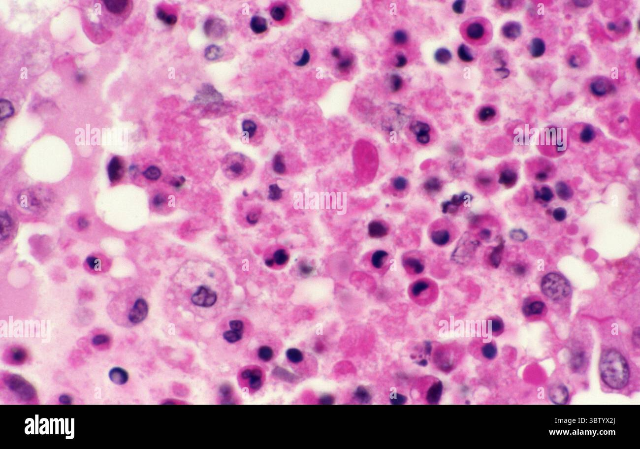 Light micrograph of a section through lung tissue with acute pneumonia ...